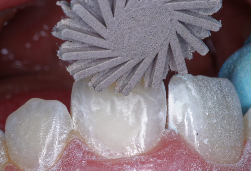 Composite Polish | Whitefern Dental Health